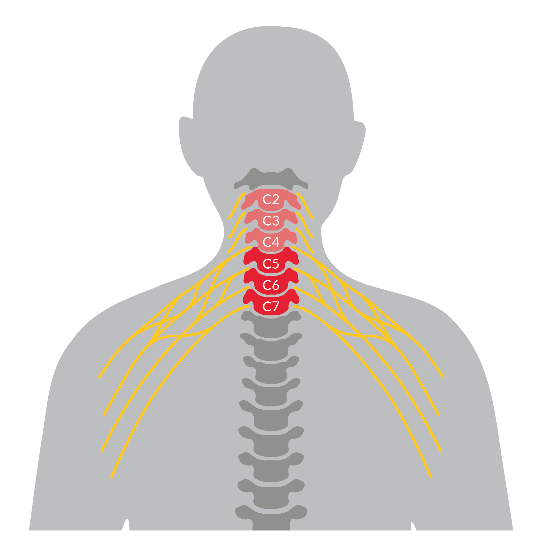 Nerve Transfer Surgery - SCIRE Community