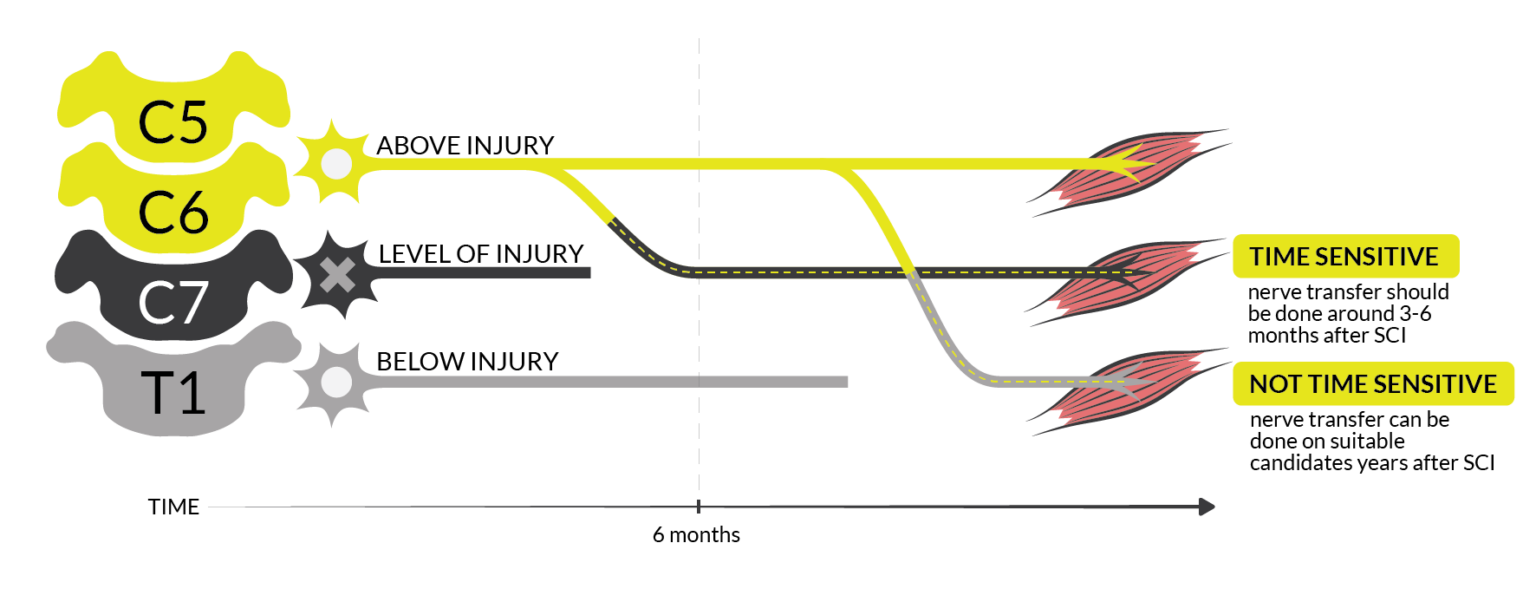 Nerve Transfer Surgery - SCIRE Community