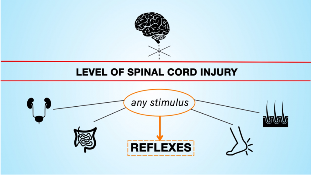 Spasticity - SCIRE Community