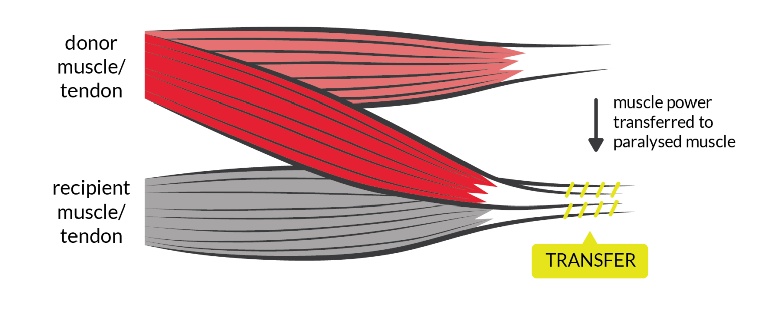 Nerve Transfer Surgery - SCIRE Community